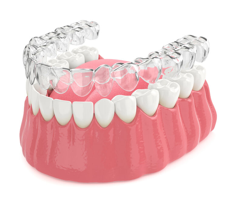 5 Things We Know You'll Love About Invisalign - Innovadent Dental ...